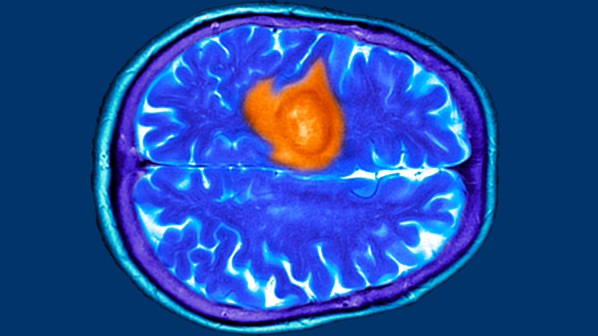 The 7 Warning Signs of Brain Cancer You Might Easily Miss | The Ugly Minute